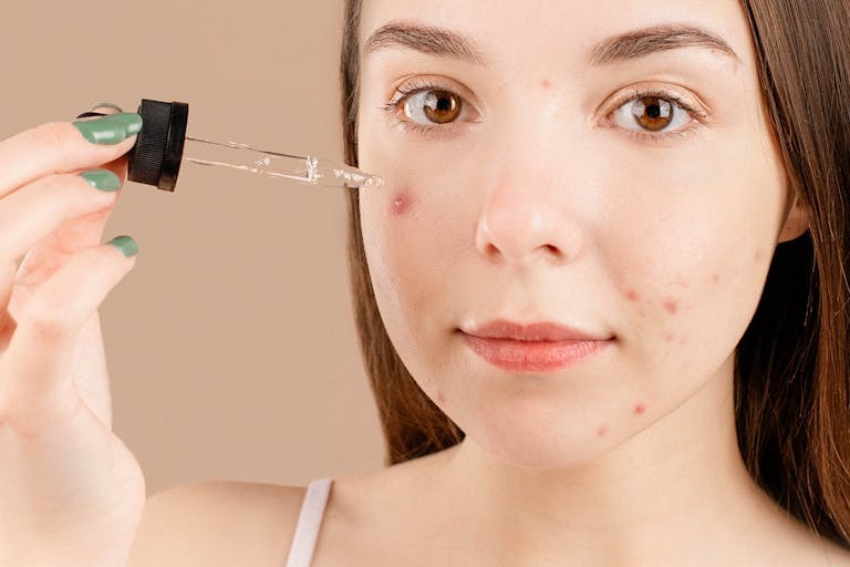 Akne Ursachen, Behandlung und Prävention: Ihr Leitfaden für eine ...