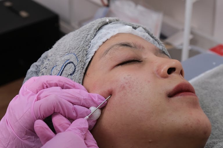 Microneedling: Ein Überblick über das Verfahren und seine Mechanismen